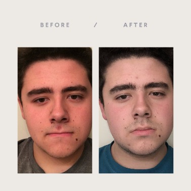 I Tried Curology Skin Care For 30 Days And These Were My Results