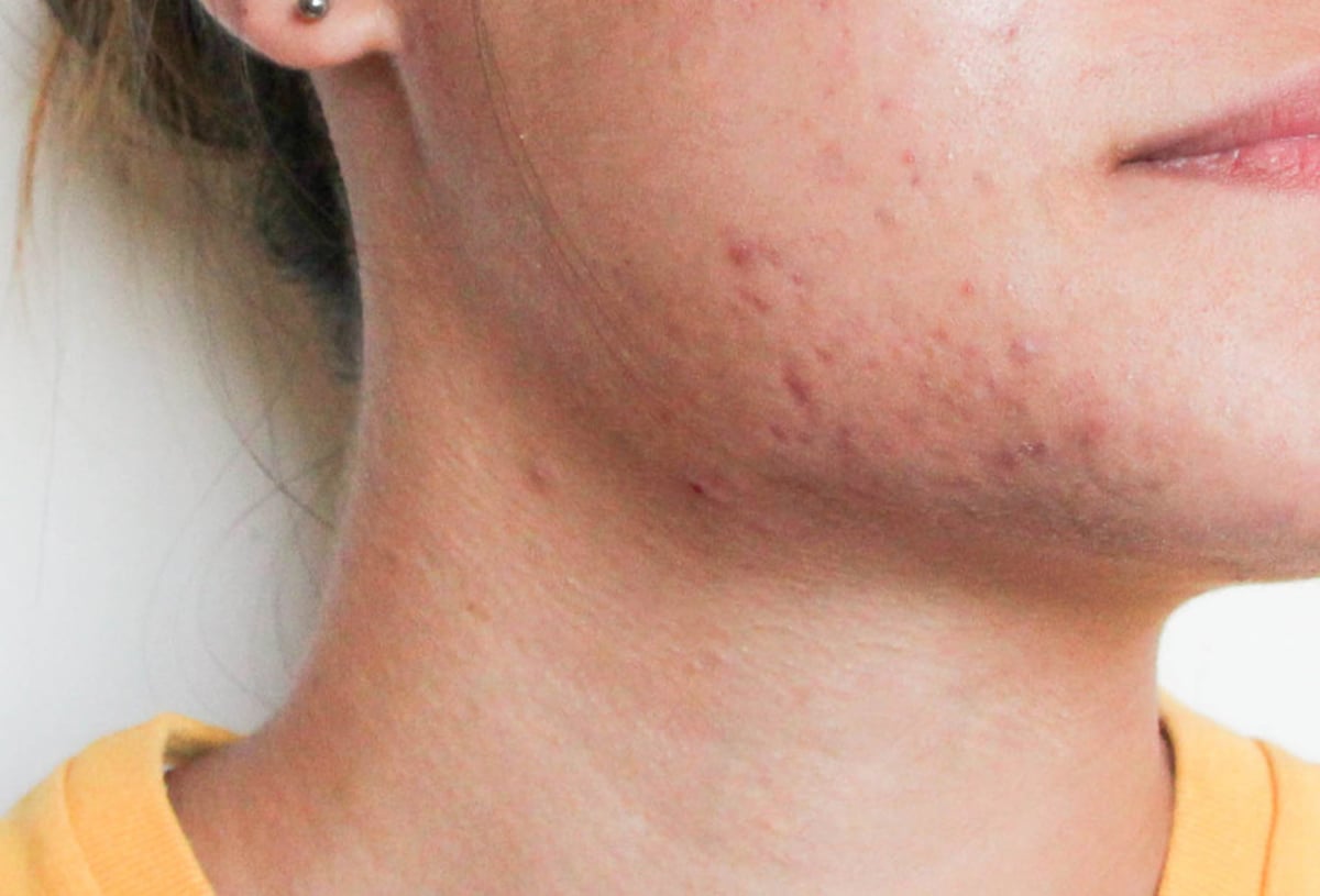 You Don’t Get Acne From Eating Greasy Food, Here’s Why