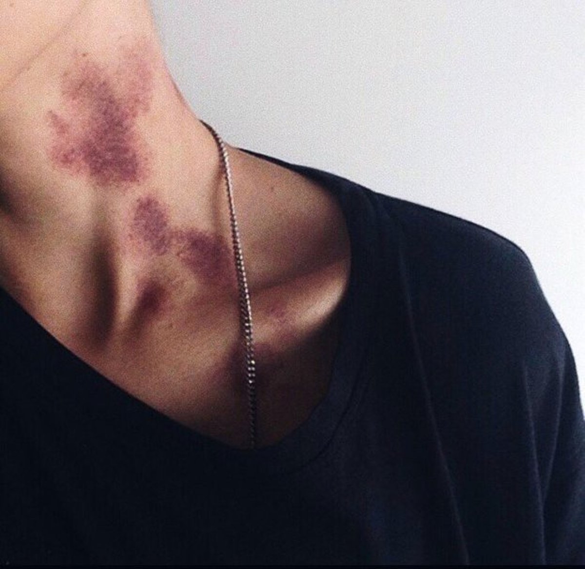 bad hickey marks