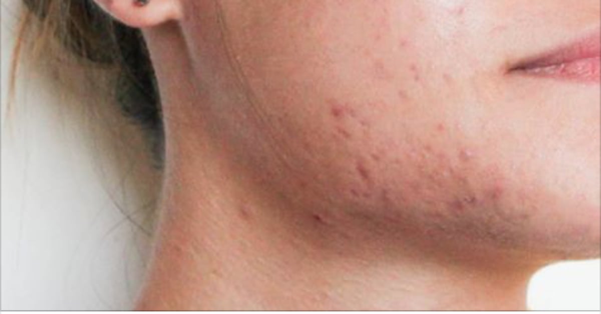 Does Alcohol Cause Acne Breakouts? Here's What Research Shows